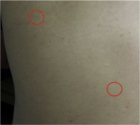 Clinical Features At Presentation Two Coin Sized Subcutaneous Nodules