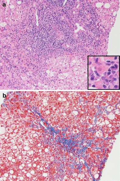 Overlap Syndrome In A Patient With Autoimmune Hepatitis Primary Download Scientific Diagram