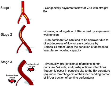 Vertebral Artery Stenosis Symptoms Captions Graphic