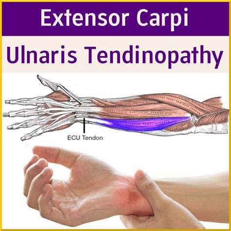 Extensor Carpi Ulnaris Tendinopathy Sports Medicine Review