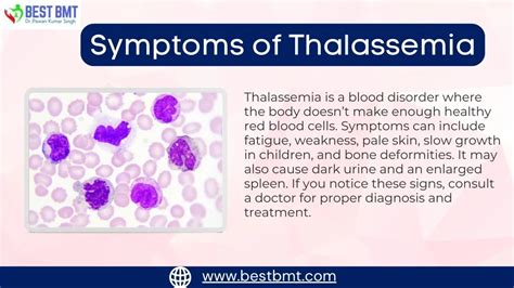 Ppt Thalassemia Explained Causes Diagnosis And Care 1 Powerpoint