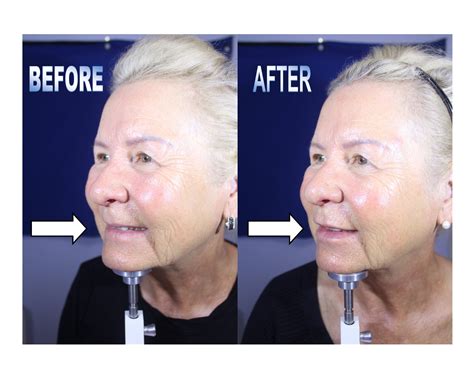 Beautiful Natural Lip Filler Results Advanced Rejuvenation Medical Spa