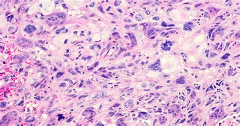 Exploring The Role Of Tea In Osteosarcoma Treatment Myths And Truths Its Never Not Teatime
