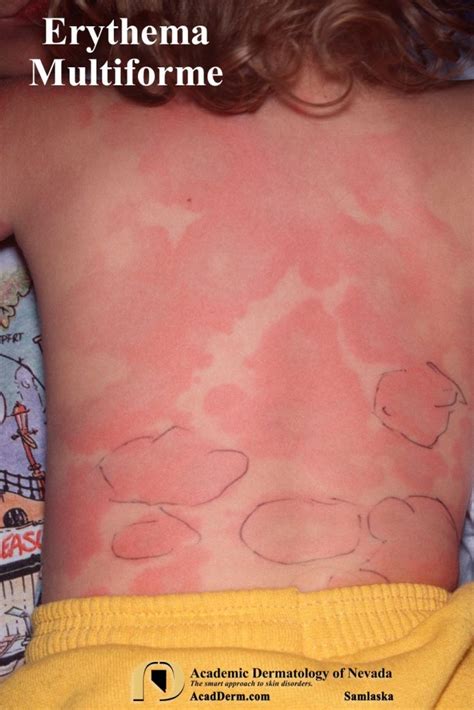 Erythema Multiforme Erythema Exudativum Multiforme Academic