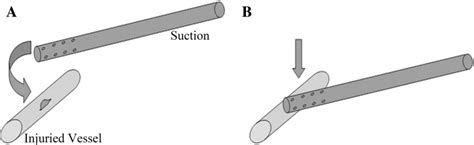 A Vascular Injury B Bleeding Control Via Side Compression Of The Download Scientific Diagram
