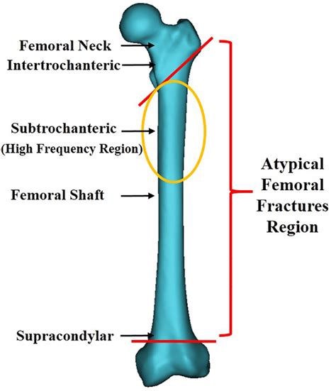 The Region Of Atypical Femur Fractures Yellow Circles Denote Areas Of Download Scientific