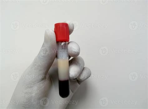 Scientist Or Biochemist Hold Test Tube With Lipemic Blood Sample High