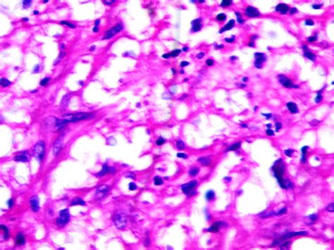 Ulceras Por Criptococosis Comportamiento En Un Paciente Inmunodeprimido Por Medicamentos Piel