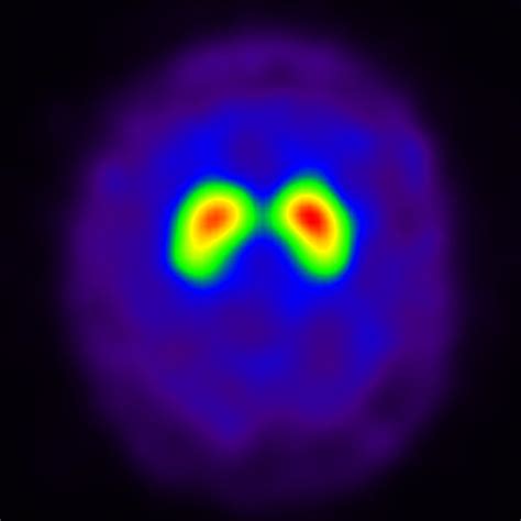 Datscan Normalbefund Nuklearmedizin Bernch Nukmedrad Klg