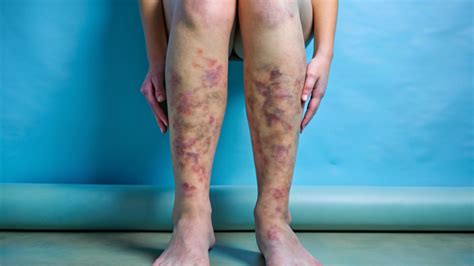 Trombose Venosa Profunda O Que é E Como Tratar Dr Douglas Sterzza