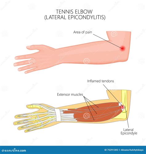 Lateral Epicondylitis Or Tennis Elbow Stock Vector Illustration Of