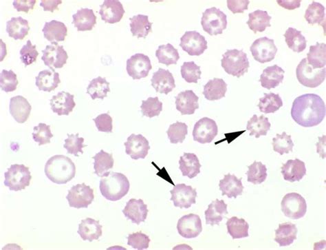 Erythrocyte Morphology Flashcards Quizlet