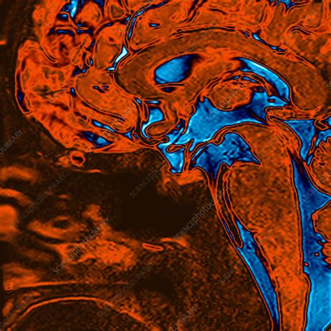 Normal Brain Mri Stock Image C030 6292 Science Photo Library