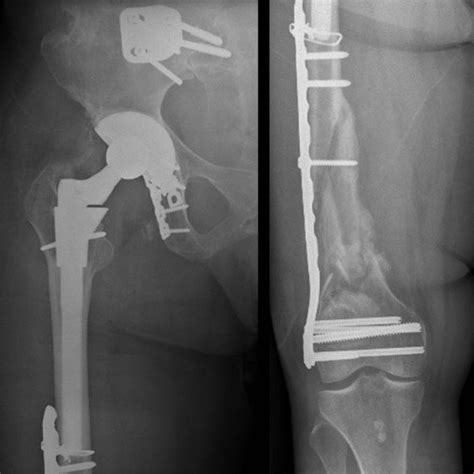 Anterior Hip Dislocation Following Revision Left Total Hip