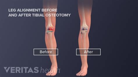 Knock Kneed Or Bow Legged Realignment By Osteotomy