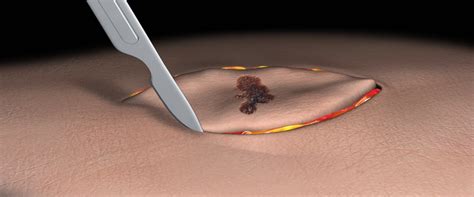 Excisional Biopsy Technique Pros And Cons