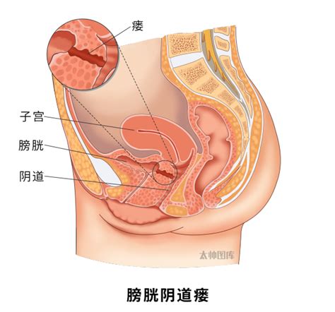 膀胱阴道瘘（标注版） 医学插画