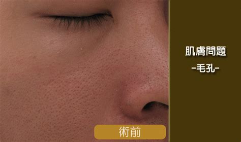 毛孔粗大怎麼辦？醫美縮毛孔有感細緻肌膚！∣彤顏皮膚管理專家