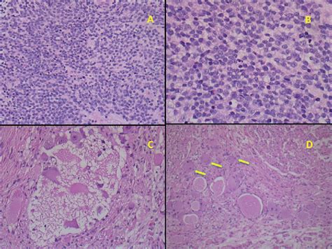 Figure 1 From The Origin Of Neuroblastoma The Origin Of Neuroblastoma Semantic Scholar