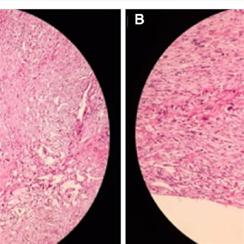 Microscopic Section Of Leiomyosarcoma Of Ivc With A G 10 He A And G