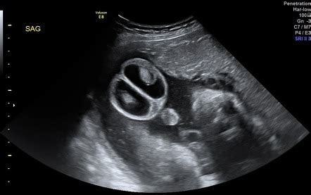 Fetal Hydrocele Ultrasound Pdf The Role Of Ultrasound In The