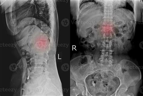 X Ray L S Spine Ap Lateral Finding Moderate Compression Fracture Of L1