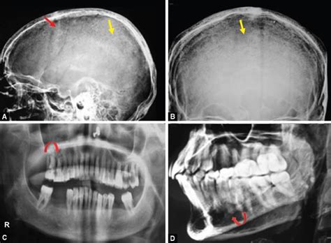 Loss Of Lamina Dura Hyperparathyroidism