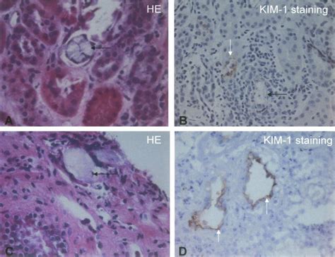 Urate Nephropathy Management Of Hyperuricemia In Patients With Chronic