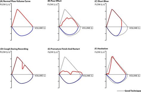 Murshida Odayil On Linkedin Common Spirometry Errors