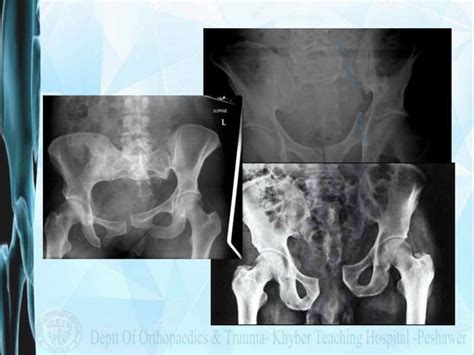 Pelvic Fracture Classification PPTX Pelvic Fracture Classification PPTX