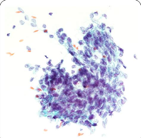 Cytology Of The Cut Surface Of The Resected Tumor Suggested A Sex Cord