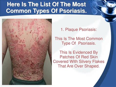 Types Of Psoriasis Causes At Pamela Adkins Blog