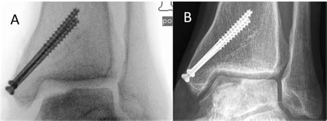 A Anteroposterior Ap Intraoperative Fluoroscopy Of The Ankle Download Scientific Diagram