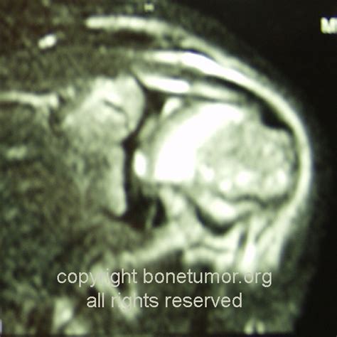 Chondroblastoma Humerus