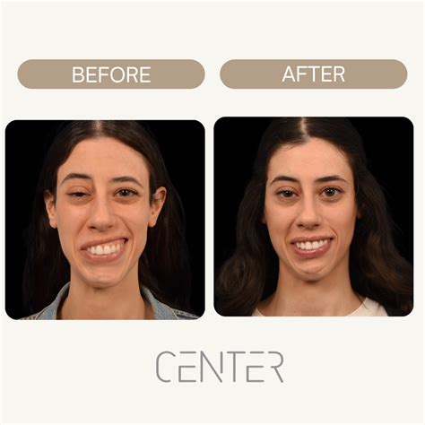 What Is Cranial Nerve 7 Palsy Facial Paralysis Institute