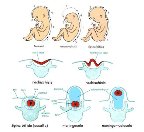 Anencephaly Diagram