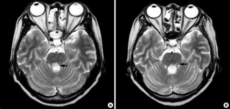 A T2 Weighted Brain Mr Image Before Treatment This Image Shows