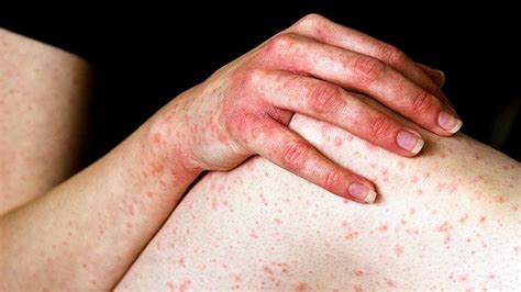 Preventing Anaphylaxis Steps To Avoid A Serious Allergic Reaction