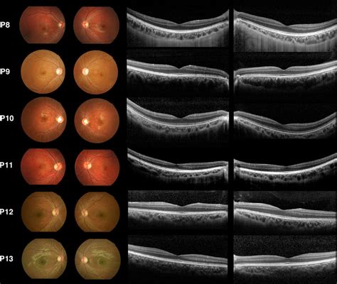 color fundus photography and macula sd oct for patients with opa1