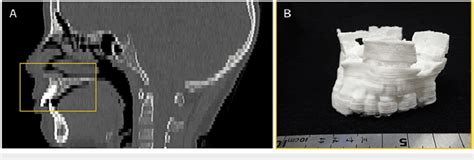 An Example Of 3d Modeling From Dicom Image Data With Too Thick Slices