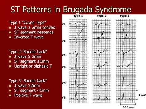 First Aid Brugada Syndrome Le Syndrome De Brugada Dynf
