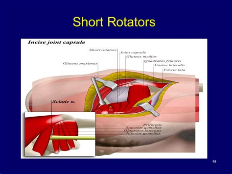 Hip Arthroplasty Approach Pdf