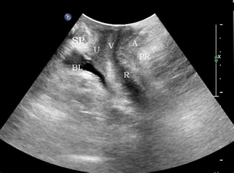 Two Dimensional Median Sagittal Plane Of Pelvic Floor Through Perineum Download Scientific