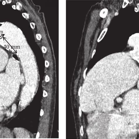 A Postoperative Ct Indicating Closed Patent Ductus Arteriosus Pda