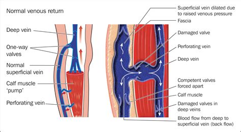Lower Extremity Venous