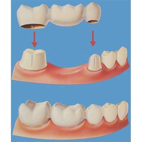 Types Of Fixed Partial Denture Bridge Design Talk
