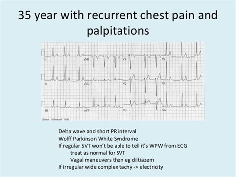 Icd 10 Atrial Flutter Merygod Icd 10 Atrial Flutter Merygod
