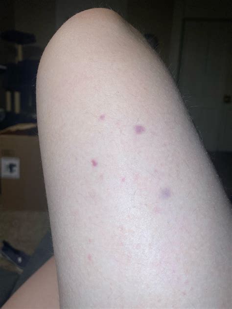 Cluster Of Tiny Bruises Rmedical