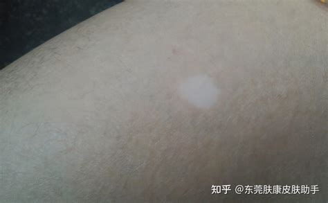 身上长白点是怎么回事呢 知乎