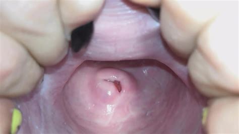 Close Cervix View